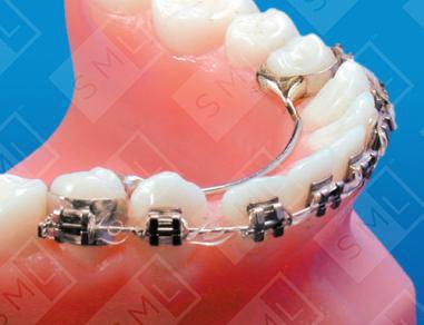 Fixed Lower Retraction Appliance L, Restorative Enhancement ...