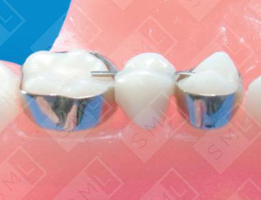Two-Band Interim Bridge w/Pontic,Teeth Movement, Dental Tools | SML