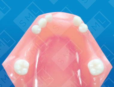 Lower Transitional Partial , Interim Partial, Orthodontic Tools | SML