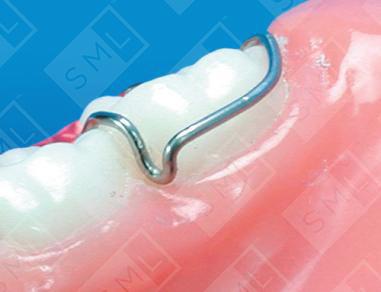 half Adams clasp is an effective clasp | SML